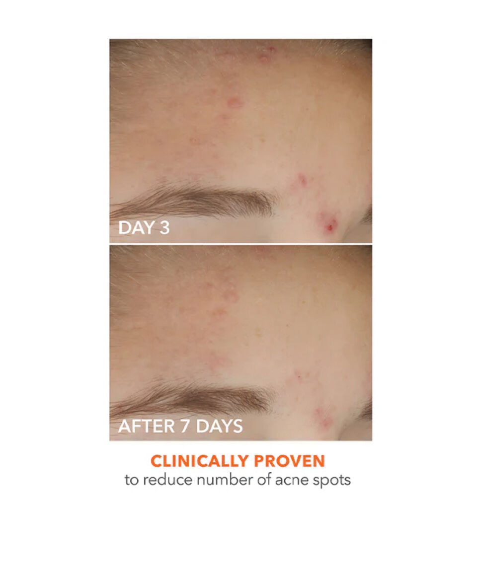 Alpha Beta® Acne Spot Treatment | Dr. Dennis Gross